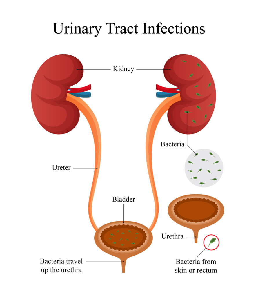 Urinary Tract Infection (UTI) Symptoms and Treatment Options